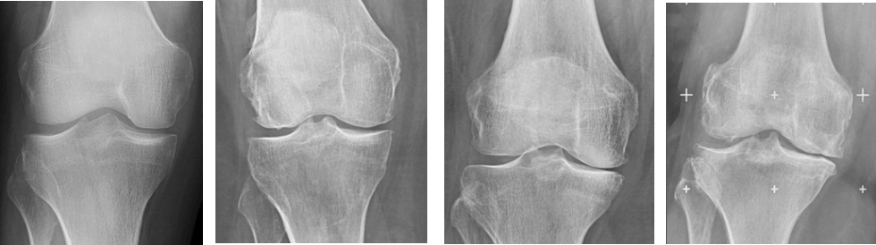 Gonartróza a chondropatie – současné možnosti diagnostiky a terapie ...